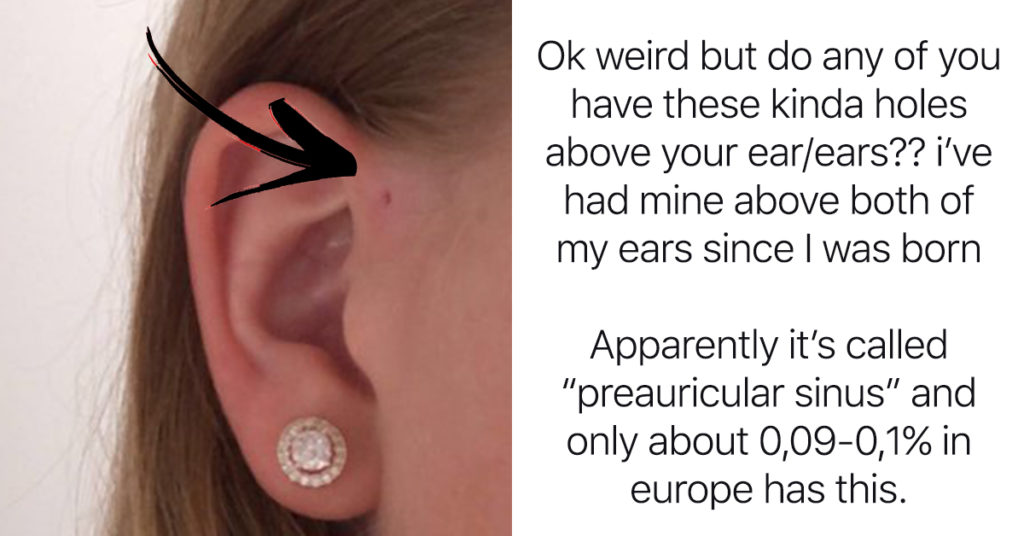 A Small Percentage Of People Are Born With Tiny Holes In Their Ears