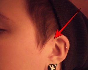 A Small Percentage Of People Are Born With Tiny Holes In Their Ears