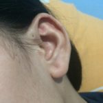 A Small Percentage Of People Are Born With Tiny Holes In Their Ears