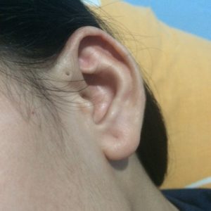 A Small Percentage Of People Are Born With Tiny Holes In Their Ears