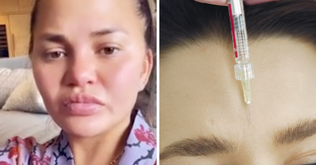 Chrissy Teigen Gets Botox For Pregnancy Headaches