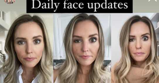 Woman Shares Her Botched Botox And Goes Viral