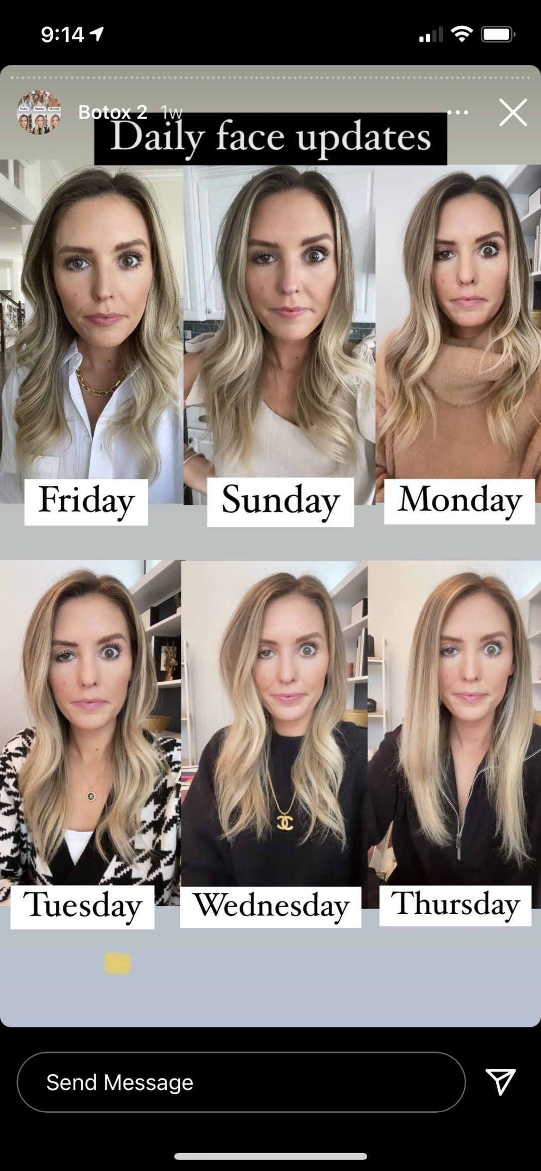 Woman Shares Her Botched Botox And Goes Viral
