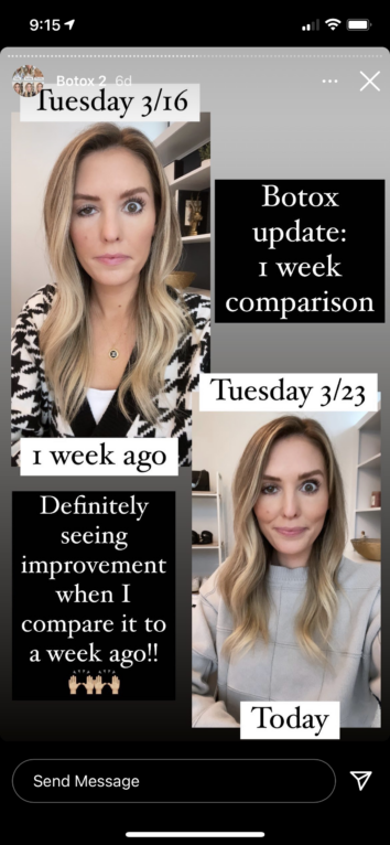 Woman Shares Her Botched Botox And Goes Viral