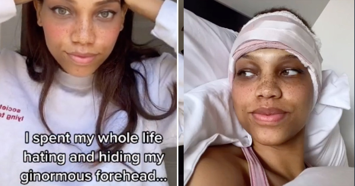 Model Gets Forehead Reduction Surgery And People Freak Out