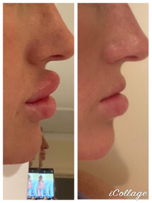 People In The "Botched Surgeries" Reddit Share Pictures Of Their Horrible Plastic Surgery Fails ...