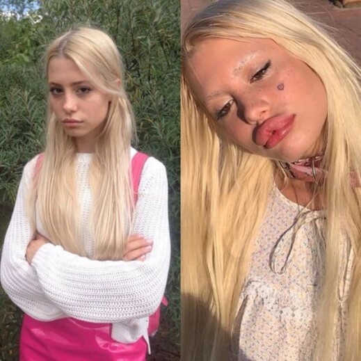 People In The "Botched Surgeries" Reddit Share Pictures Of Their ...