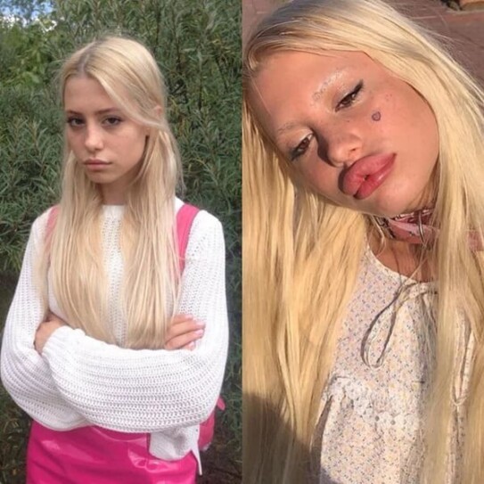 People In The "Botched Surgeries" Reddit Share Pictures Of Their ...