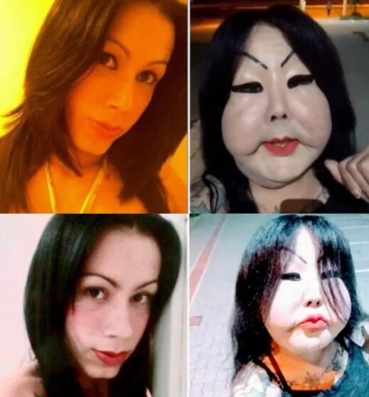 People In The "Botched Surgeries" Reddit Share Pictures Of Their ...