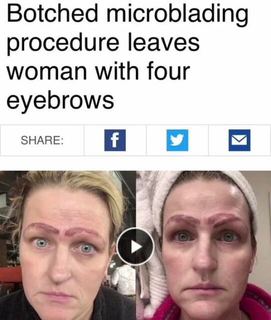 People In The "Botched Surgeries" Reddit Share Pictures Of Their ...