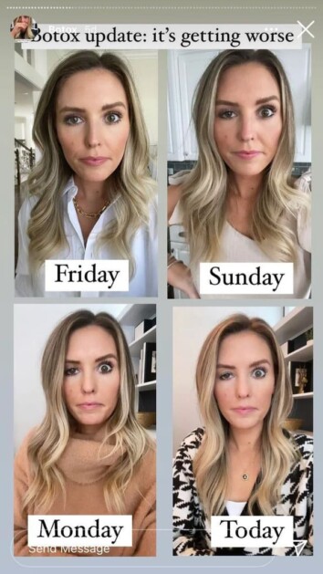 People In The "Botched Surgeries" Reddit Share Pictures Of Their ...