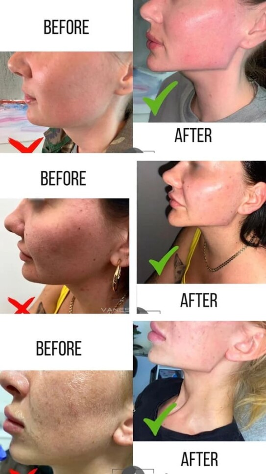 People In The "Botched Surgeries" Reddit Share Pictures Of Their ...