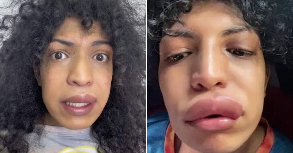 Woman's Allergic Reaction And Swollen Lip Triggered By Makeout Session