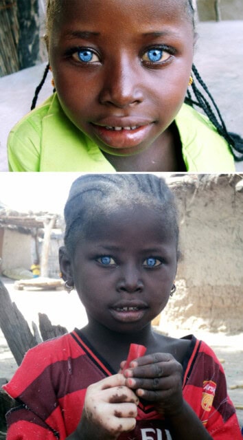 50 Photos Of People Showing Off Their Unique Genetic Traits
