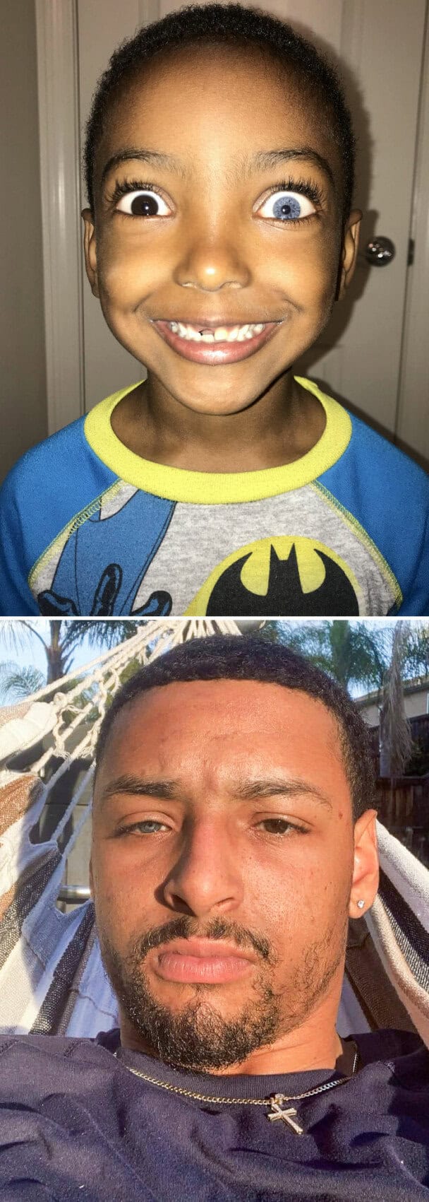 50 Photos Of People Showing Off Their Unique Genetic Traits