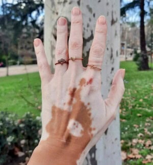 50 Photos Of People Showing Off Their Unique Genetic Traits