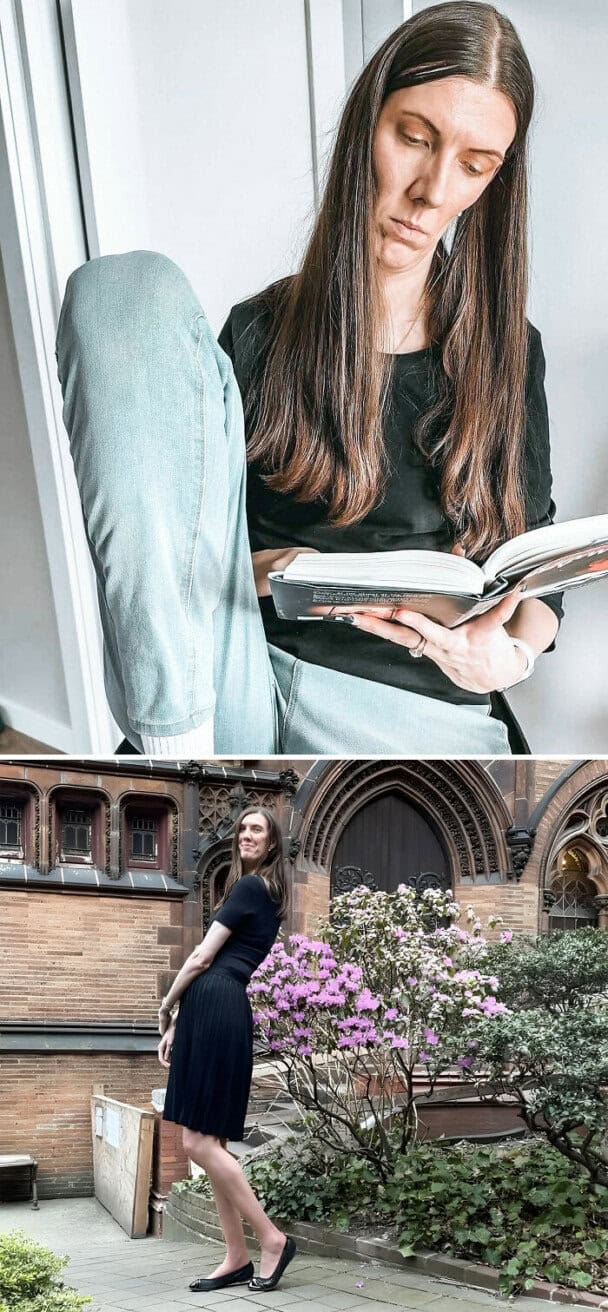 50 Photos Of People Showing Off Their Unique Genetic Traits